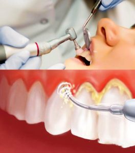 Sri Sinar Dental Clinic | General Dental Treatment – Scaling / Polishing